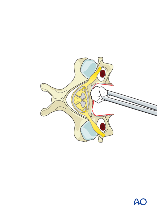 Anterior corpectomy and stabilzation for Subaxial cervical, unstable ...