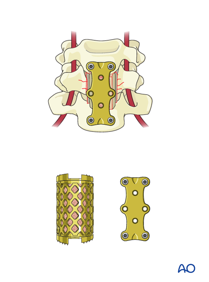 Anterior corpectomy and stabilzation for Subaxial cervical, unstable ...
