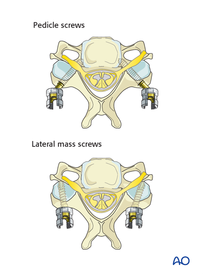 Posterior decompression and stabilization C3-C7 for Subaxial cervical ...