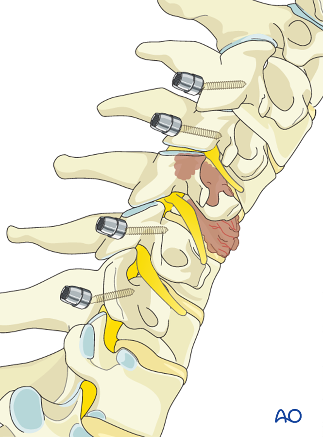 Posterior stabilization C3-C7 for Subaxial cervical, unstable, low ESCC