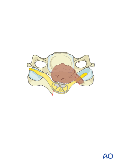 Posterior decompression and stabilization C3-C7 for Subaxial cervical ...