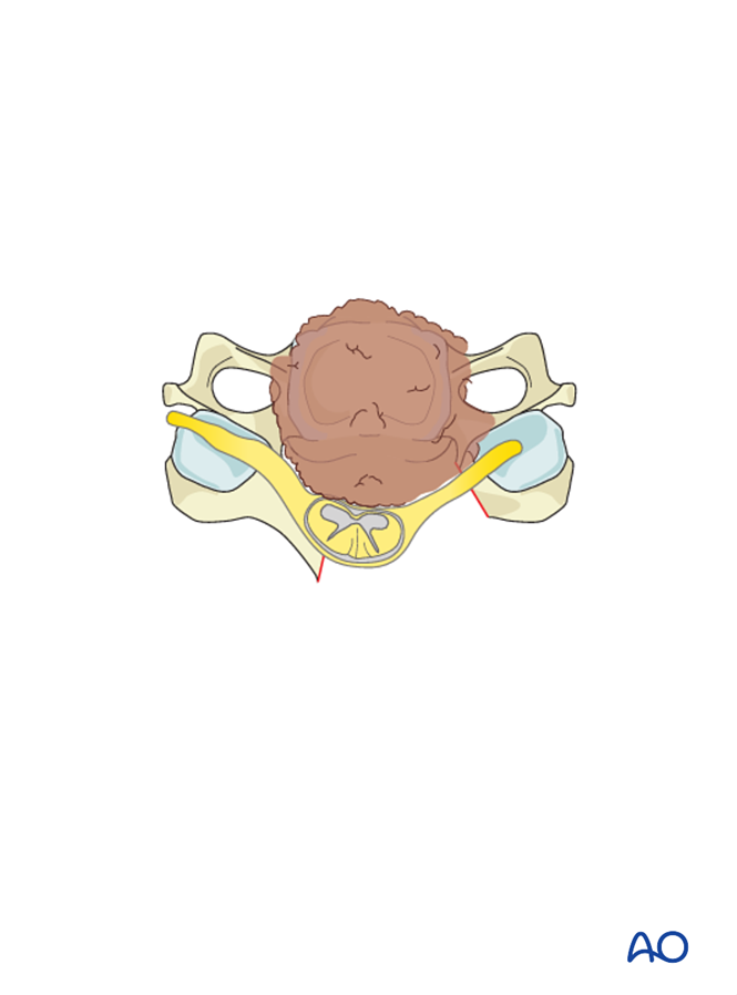 Posterior decompression and stabilization C3-C7 for Subaxial cervical ...