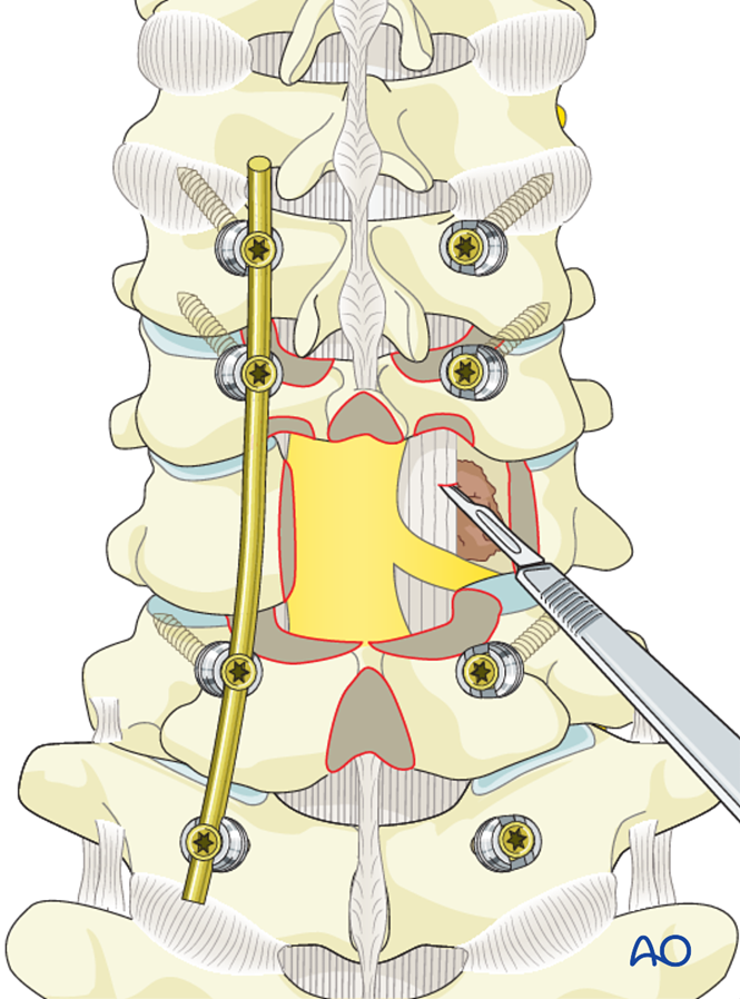 Posterior decompression and stabilization C3-C7 for Subaxial cervical ...
