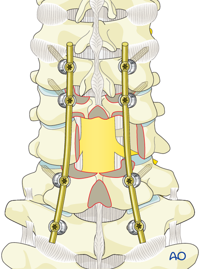 Posterior decompression and stabilization C3-C7 for Subaxial cervical ...