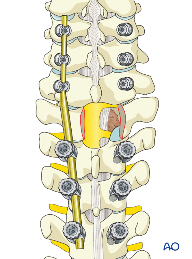 Posterior decompression and stabilization C7-T1 for Subaxial cervical ...