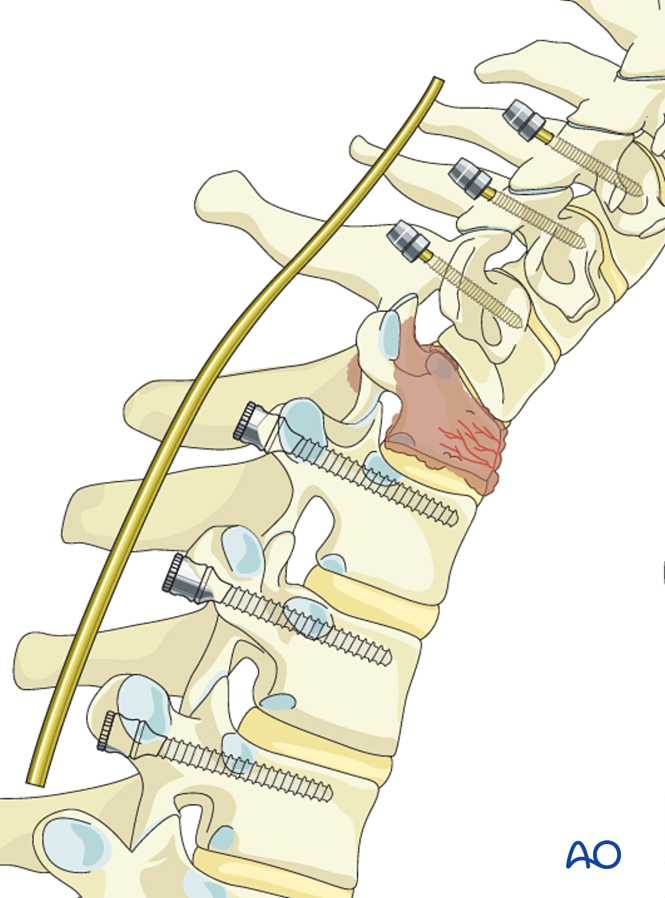 Posterior decompression and stabilization C7-T1 for Subaxial cervical ...