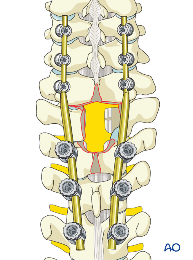 Posterior decompression and stabilization C7-T1 for Subaxial cervical ...