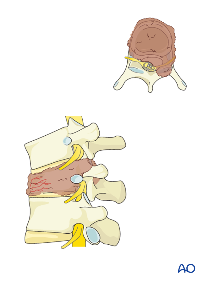 Posterior decompression and stabilization with corpectomy for ...