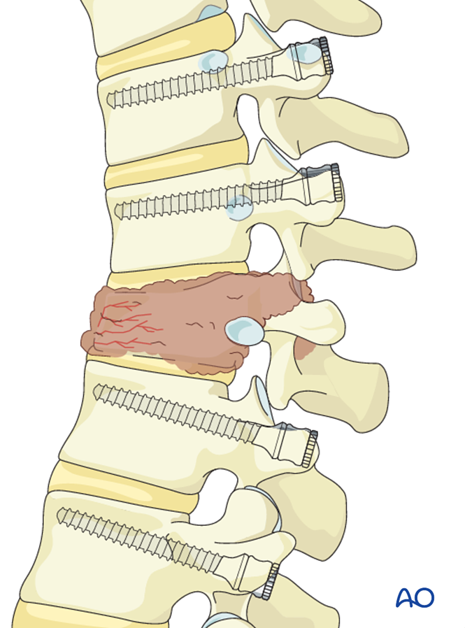 Posterior decompression and stabilization for Thoracolumbar, unstable ...