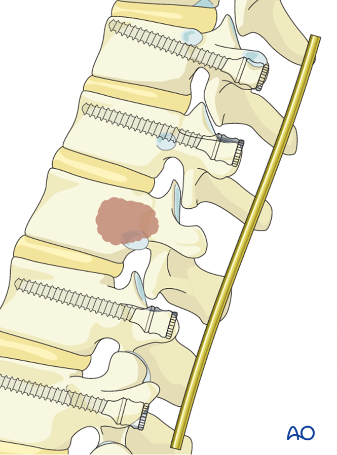 Posterior decompression and stabilization for Thoracolumbar, stable ...