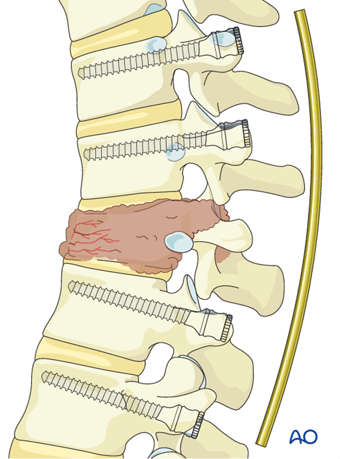 Posterior decompression and stabilization with corpectomy for ...