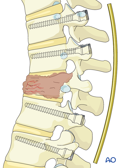 Posterior stabilization for Thoracolumbar, unstable, low ESCC