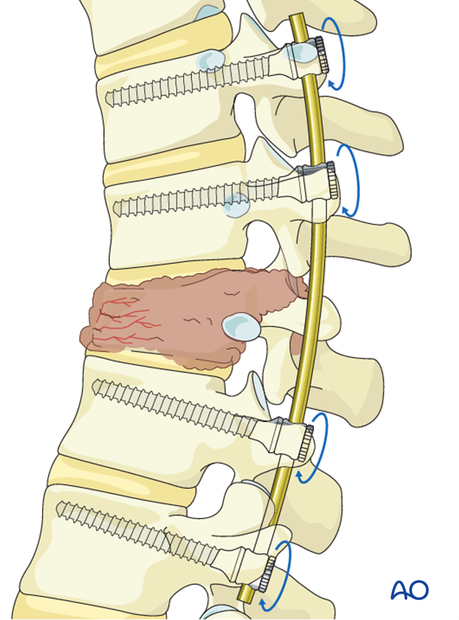 Posterior decompression and stabilization with corpectomy for ...