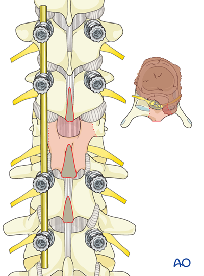 Posterior decompression and stabilization with corpectomy for ...