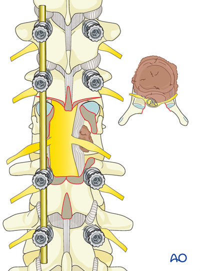 Posterior decompression and stabilization with corpectomy for ...