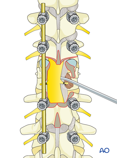 Posterior decompression and stabilization for Thoracolumbar, unstable ...