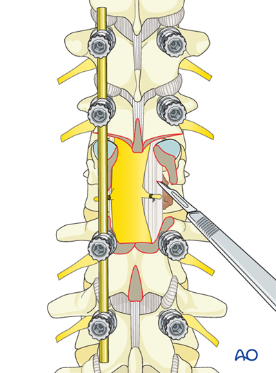 Posterior decompression and stabilization with corpectomy for ...