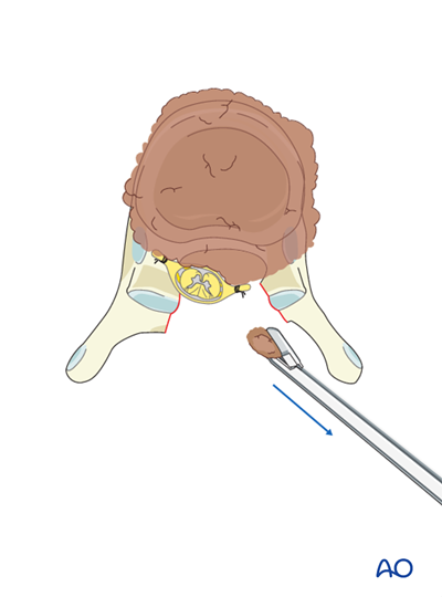 Posterior decompression and stabilization for Thoracolumbar, unstable ...