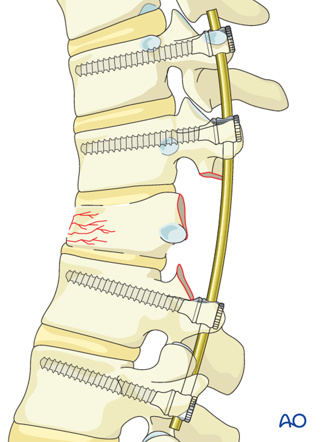 Posterior decompression and stabilization for Thoracolumbar, unstable ...