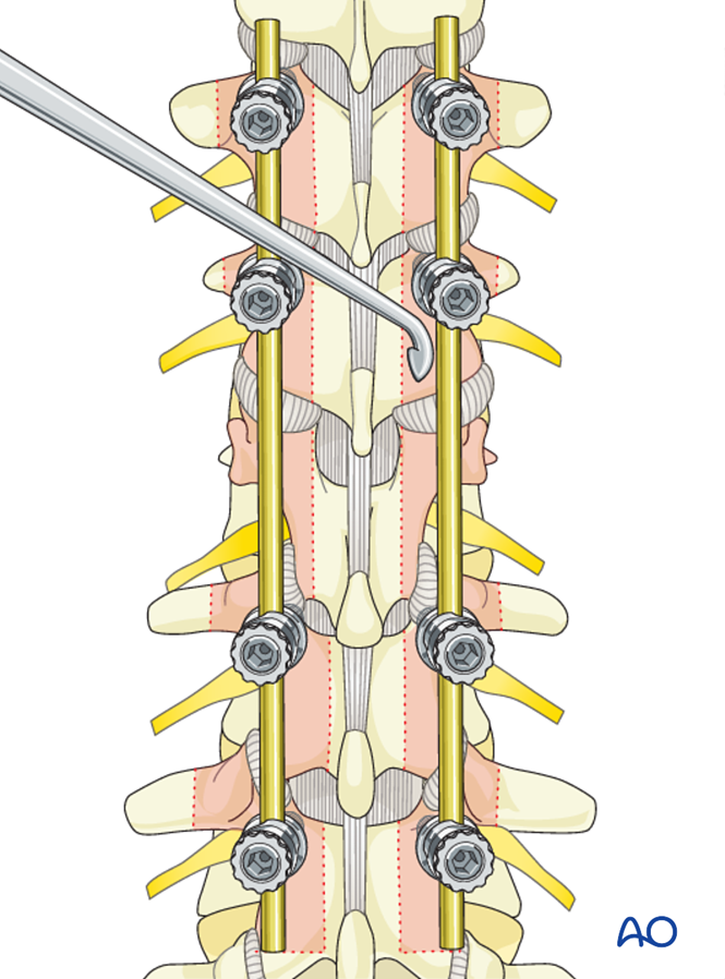 Posterior stabilization for Thoracolumbar, unstable, low ESCC