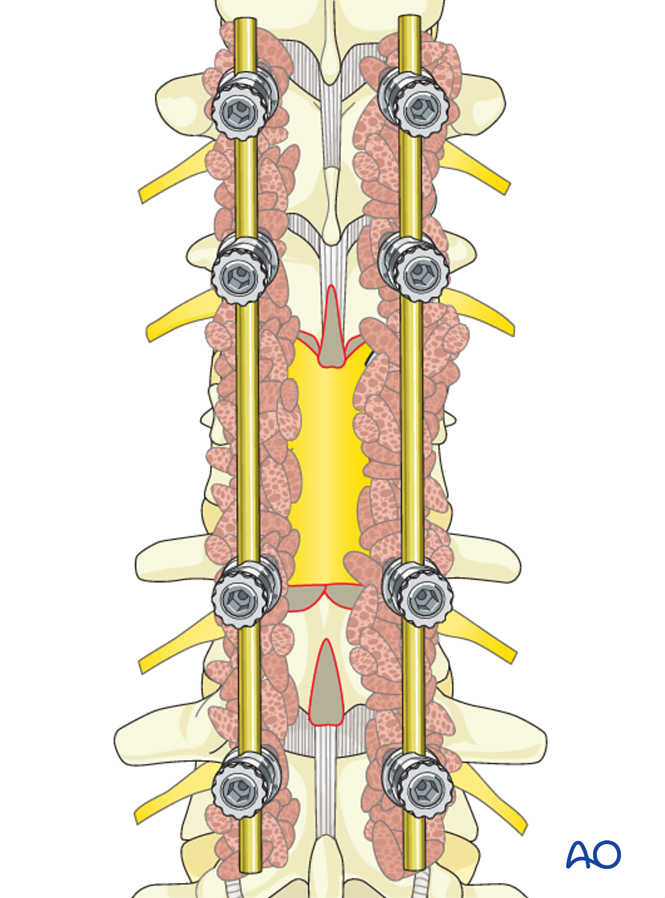 Posterior decompression and stabilization for Thoracolumbar, unstable ...