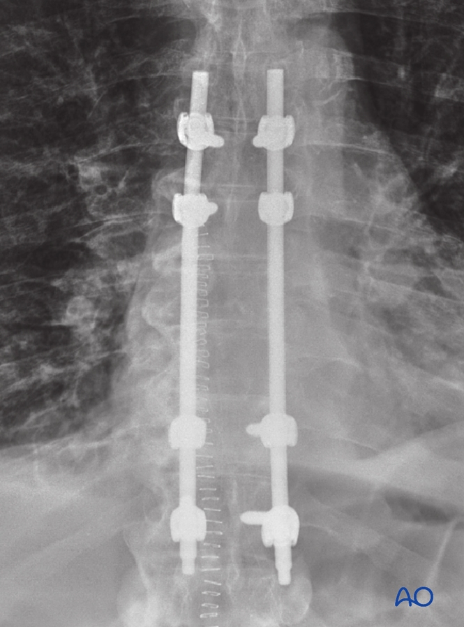 Posterior decompression and stabilization for Thoracolumbar, stable ...