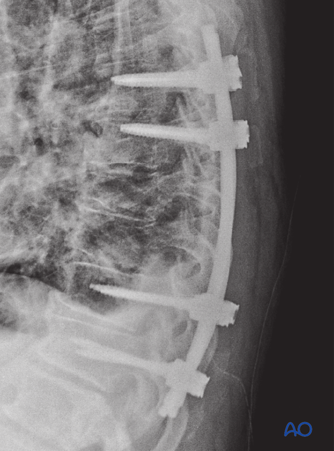 Posterior decompression and stabilization for Thoracolumbar, unstable ...