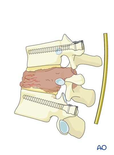 Posterior MIS for Thoracolumbar, unstable, high ESCC