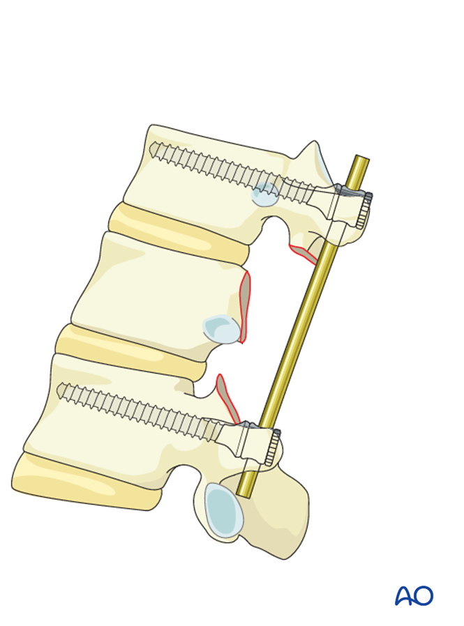 Posterior MIS for Thoracolumbar, stable, high ESCC