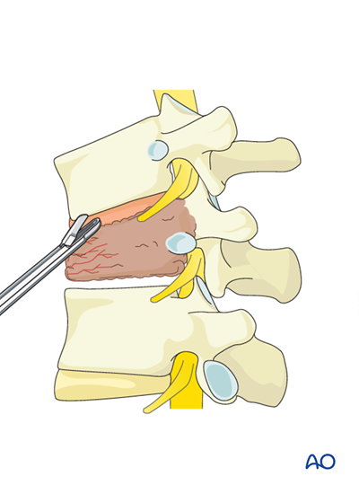 Anterior corpectomy and stabilization for Thoracolumbar, unstable, high ...
