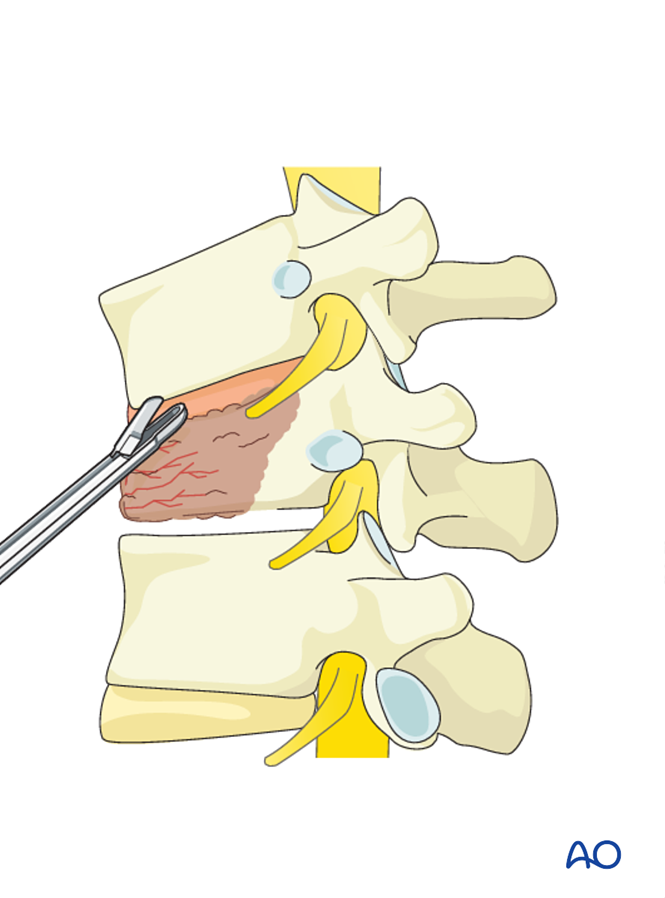 Anterior corpectomy and stabilization for Thoracolumbar, unstable, low ESCC