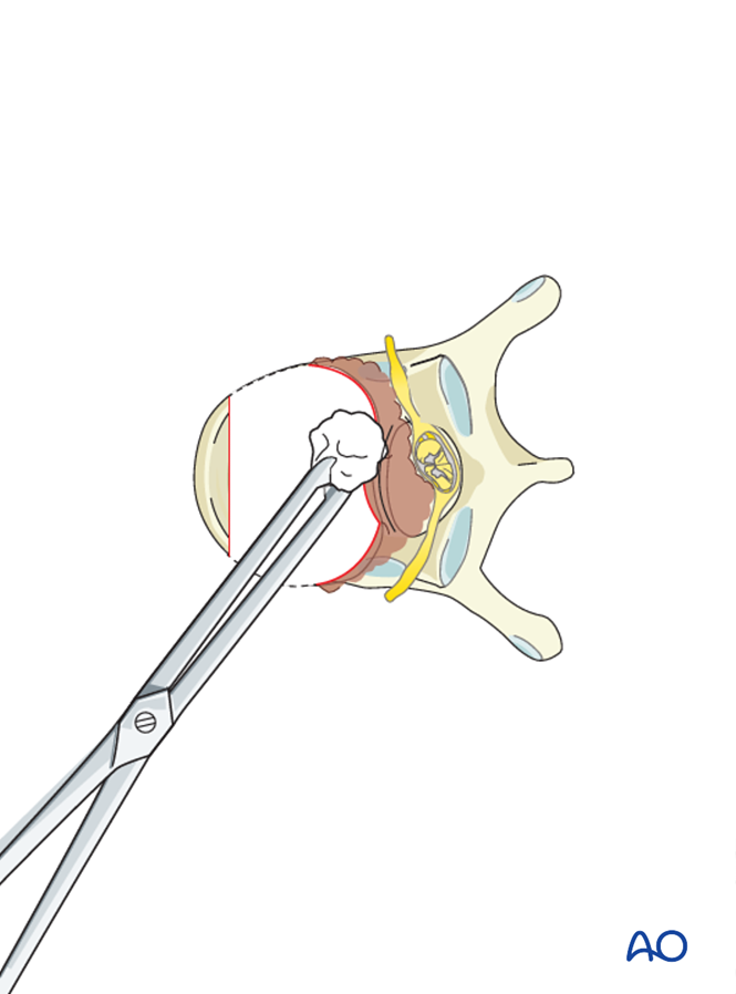 Anterior corpectomy and stabilization for Thoracolumbar, unstable, high ...