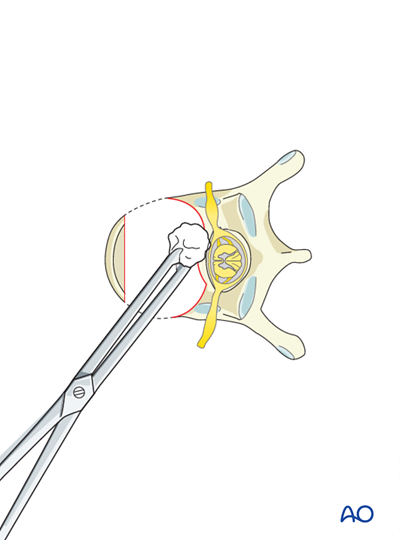 Anterior corpectomy and stabilization for Thoracolumbar, unstable, low ESCC