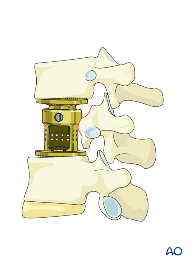 Anterior corpectomy and stabilization for Thoracolumbar, unstable, high ...