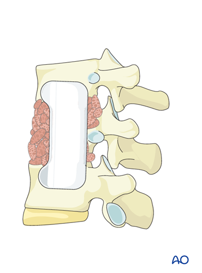Anterior corpectomy and stabilization for Thoracolumbar, unstable, high ...
