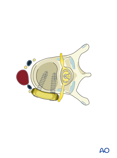Anterior corpectomy and stabilization for Thoracolumbar, unstable, high ...