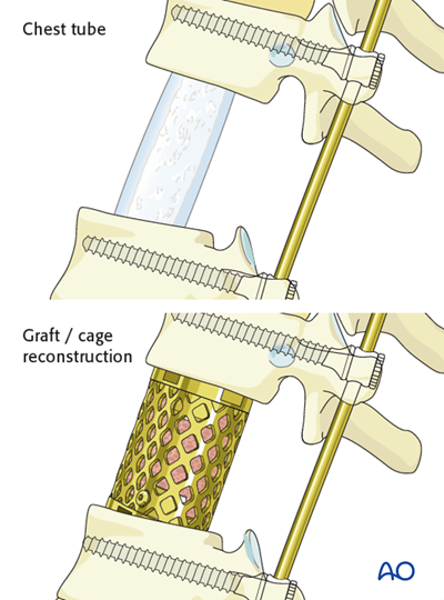 Posterior decompression and stabilization with corpectomy for ...