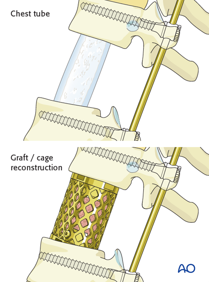 Posterior decompression and stabilization with corpectomy for ...