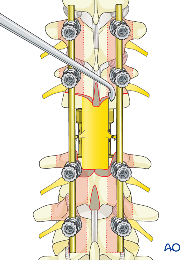 Posterior decompression and stabilization with corpectomy for ...