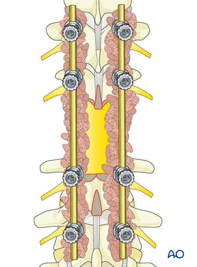 Posterior decompression and stabilization with corpectomy for ...