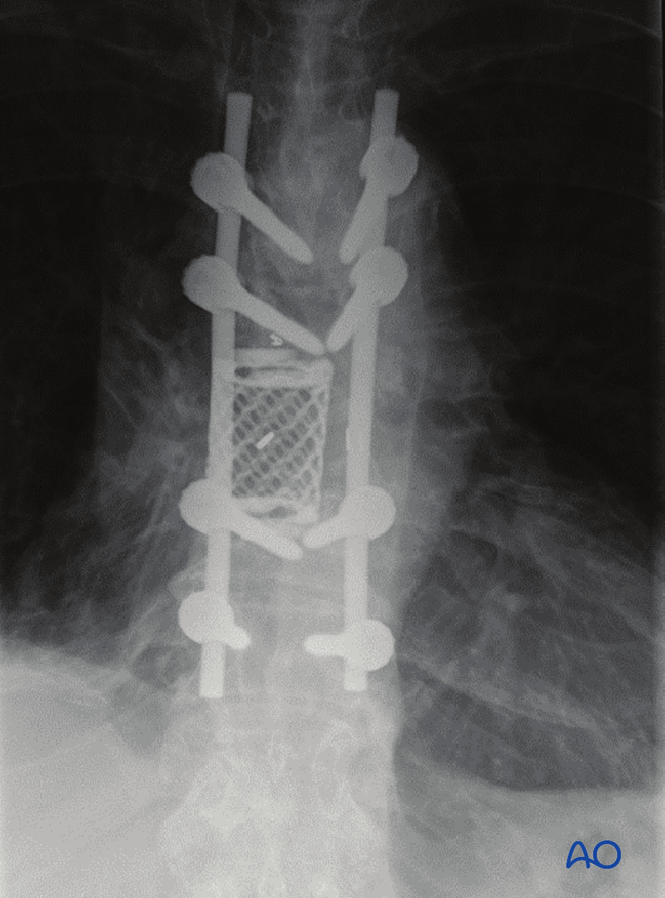 Posterior decompression and stabilization with corpectomy for ...