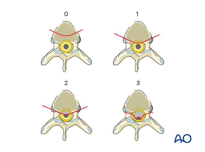 Spinal cord compression scale