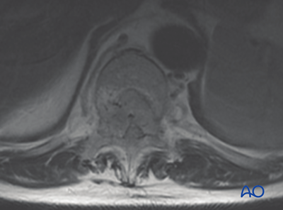 Spinal cord compression scale