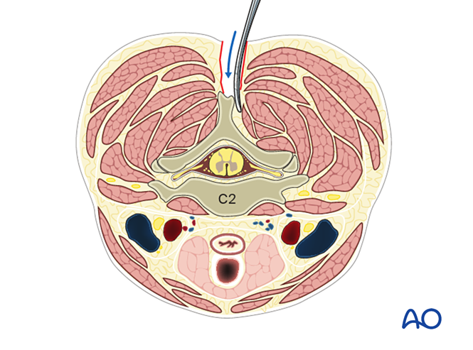 Posterior access to the occipitocervical spine (C0–C2)