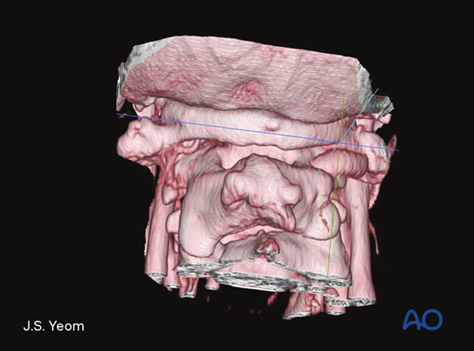 Posterior access to the occipitocervical spine (C0–C2)