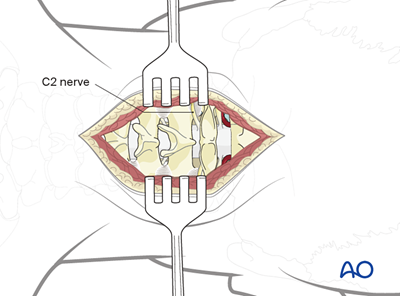 En bloc resection of an anterior tumor (C1 to C7) for Benign cervical ...
