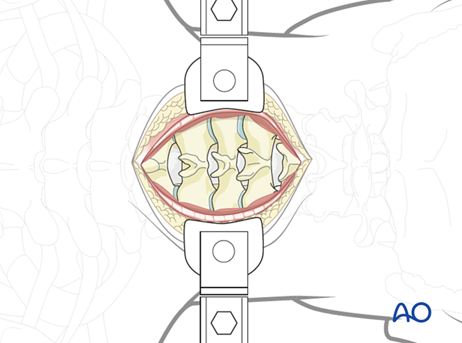 Posterior access to the cervical spine (C3–C7)
