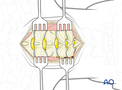 Posterior access to the cervicothoracic junction (C7–T2)