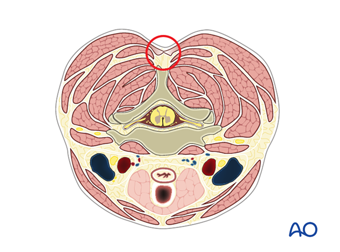 Posterior access to the cervicothoracic junction (C7–T2)