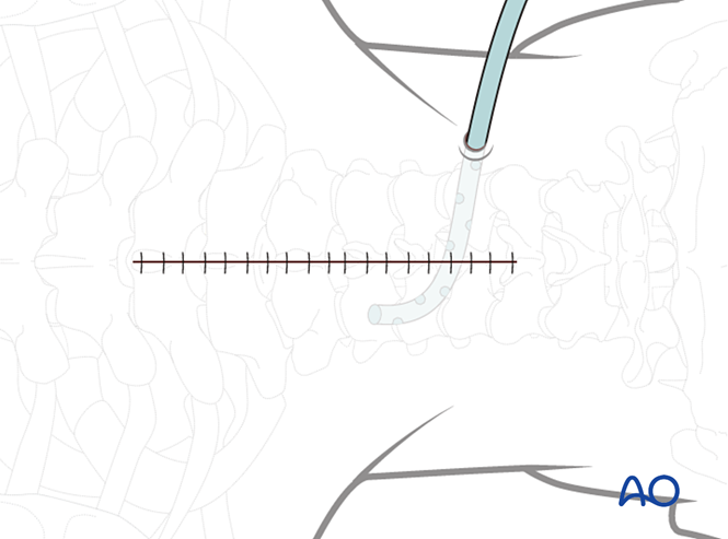 Posterior access to the cervicothoracic junction (C7–T2)